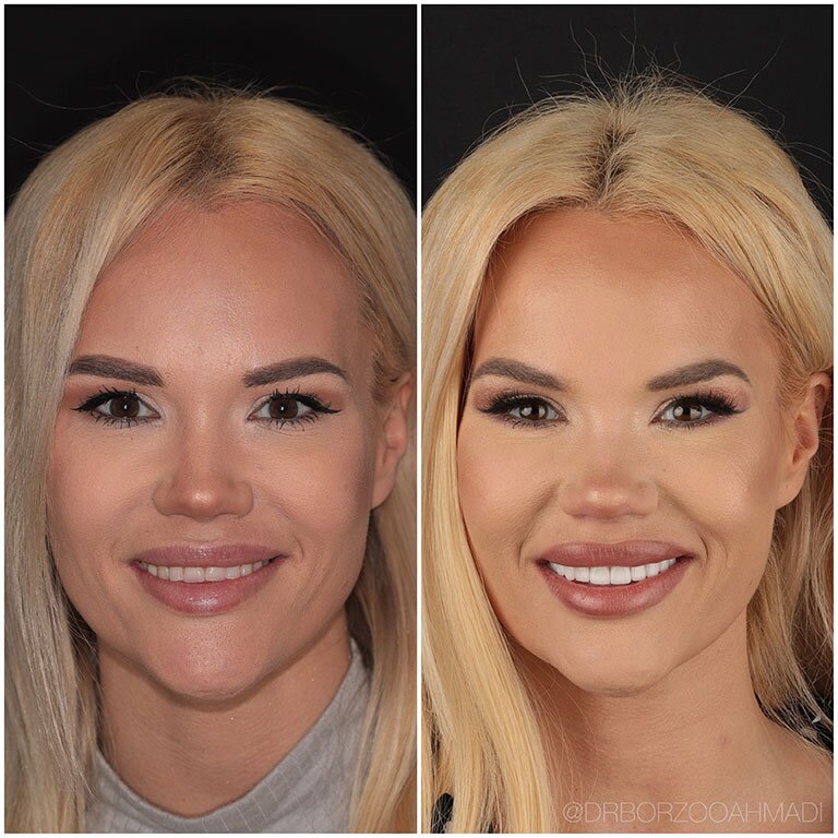 Chipped Teeth Beverly Hills | The Porcelain Veneers Solution | Dr. Ahmadi