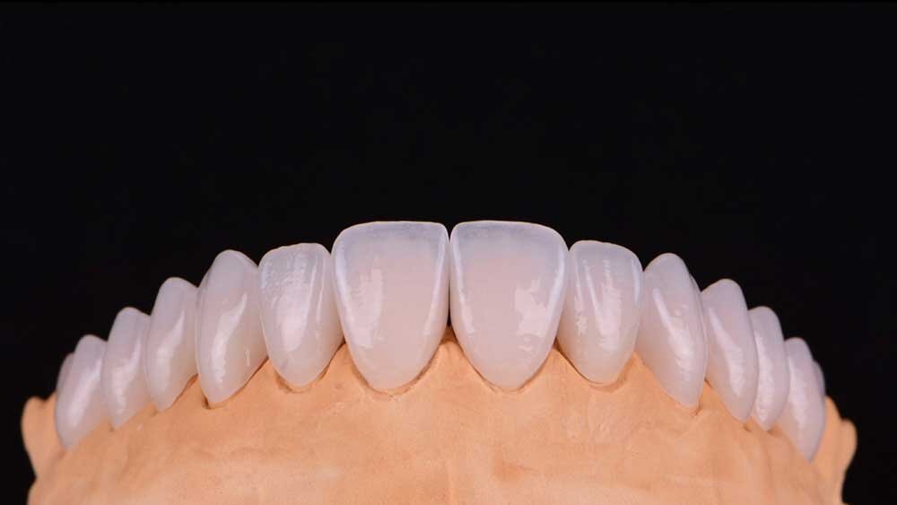 Porcelain Veneers Beverly Hills | Veneers West Hollywood | Dr. Borzoo